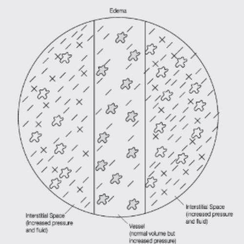 Ethacrynic Acid Management of Third Spacing - Vibrant IP